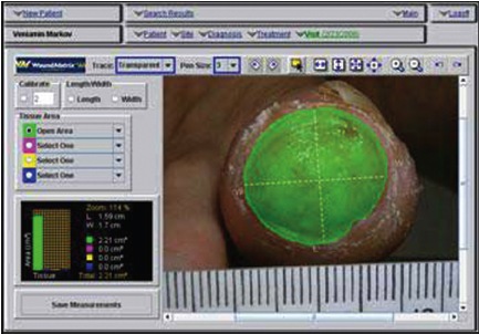 Digital Wound Measurement and Tracking System - Tech Briefs
