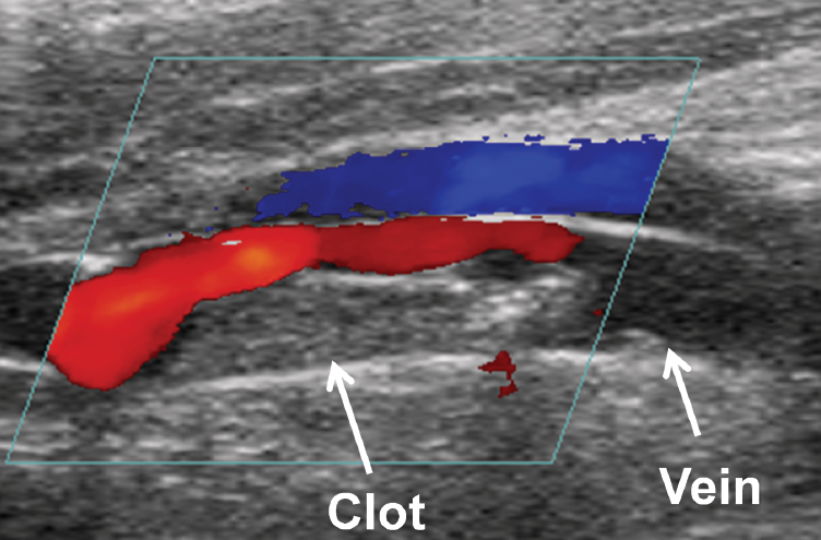 Ultrasound Technique Breaks Down Blood Clots - Medical Design Briefs